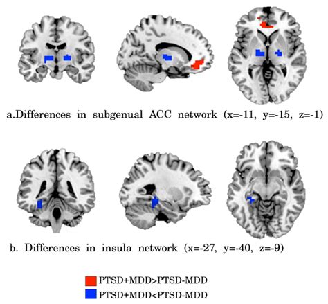 Clusters Of Significant Different Functional Connectivity Of The Insula Download Scientific