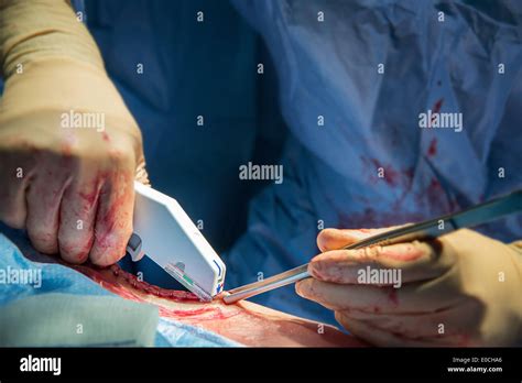 Staples Hip Replacement Surgery