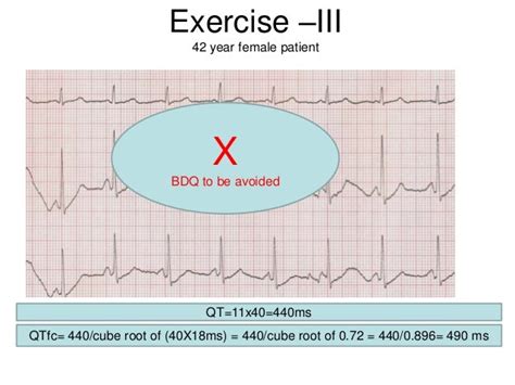 Excercise Corrected Qt Interval Q Tc Ecg Interpretation