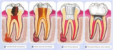 Root Canal Treatment Rct Malaga Dental Clinic