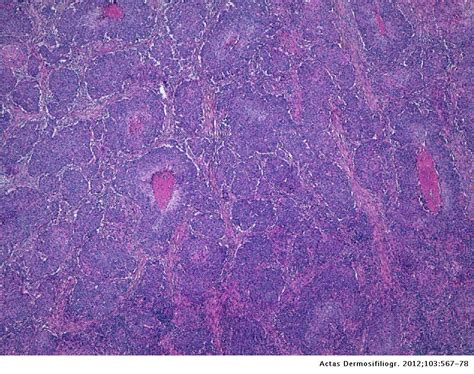 Epidermoid Carcinoma