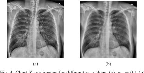 Figure 4 From Viral Pneumonia Detection From Chest X Rays Using Glcm And Lbp Features Semantic