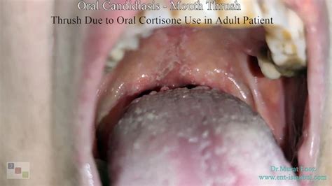 Thrush Due To Oral Cortisone Use In Adult Patient