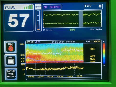 Signature Of Ketamine On Eeg During Multimodal Anesthesia I Have