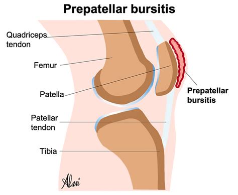 Prepatellar Bursitis Aspiration And Cortisone Injection Musculoskeletal