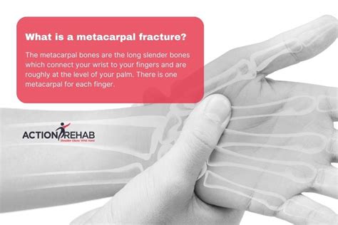 Metacarpal Fractures Causes And Recovery Action Rehab