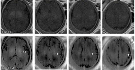 Axial Images From T1 Fast Field Echo Sequence T1 Ffe Upper Row And