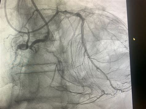 Maryam Al Dhubaiki On Linkedin Successful Pci To Cto Rca Using Reverse