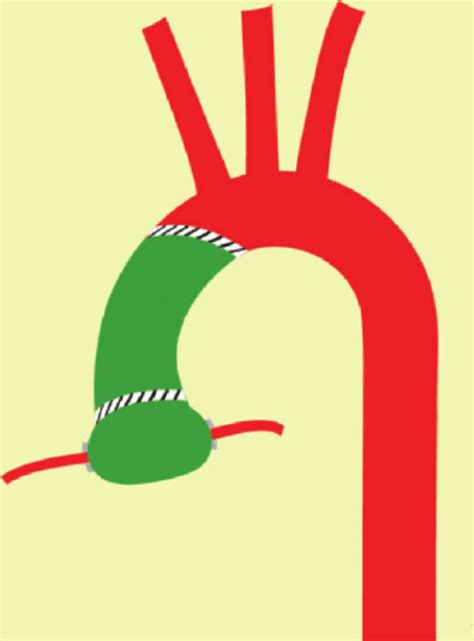 Aortic Valvesparing Procedure Diagram Shows The Valve Sparing Download Scientific Diagram