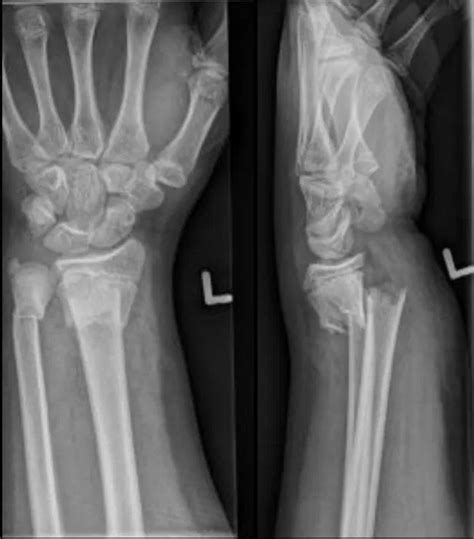 Colle Fracture Distal Radial Fracture Radiology Case Radiogyan