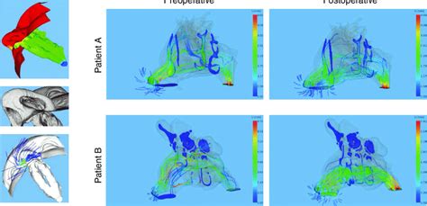 Computational Fluid Dynamics For Handling Nasal Surgery A Cfd For Download Scientific Diagram