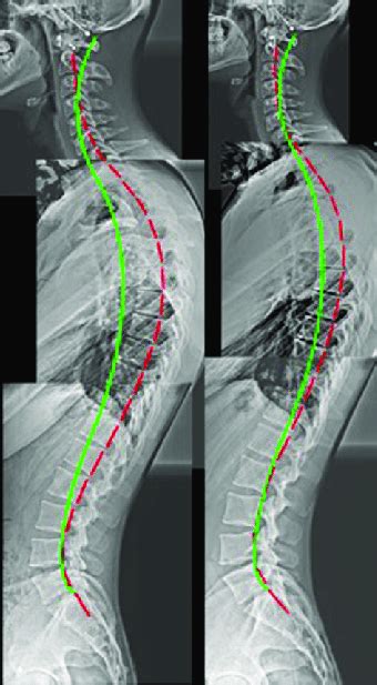 Chiropractic Spine Alignment