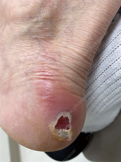 Abscess In Cellulitis Stock Image C0604028 Science Photo Library