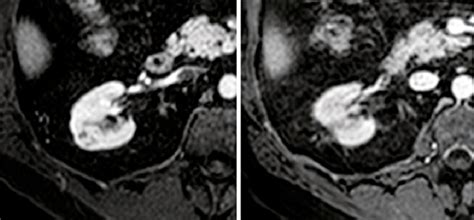 Mri Pre And After Ablation Download Scientific Diagram
