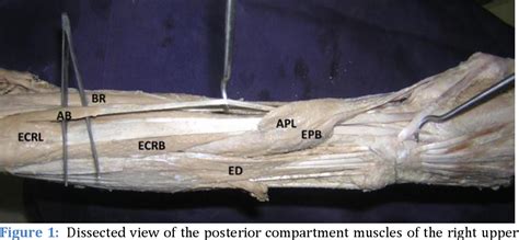 Extensor Pollicis Longus Cadaver