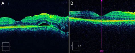 Posterior Scleritis Prognosis At Brodie Puddy Blog