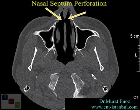 We Performed Again Revision Rhinoplasty Operation Septum Perforation