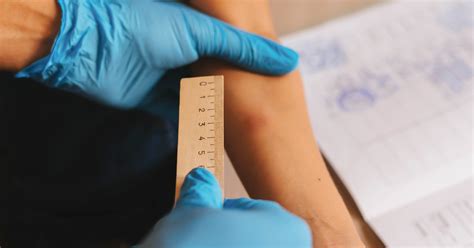 Tb Skin Test In Hong Kong Everything You Need To Know For Studying