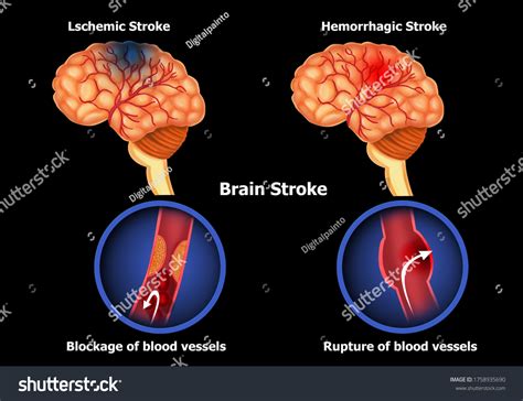 Illustration Brain Stroke Cerebral Hemorrhage Stock Illustration