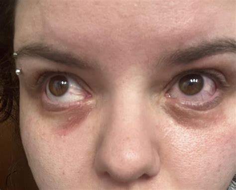 Rash Around Eyes Rdermatology