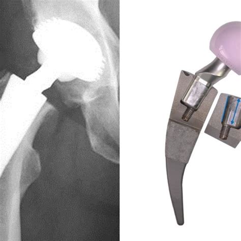 Pdf How To Proceed With Asymptomatic Modular Dual Taper Hip Stems In The Case Of Acetabular