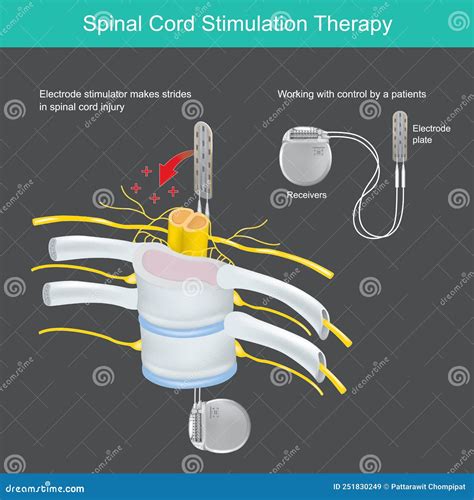 Spinal Cord Stimulation Therapy Stock Vector Illustration Of Nerve Bone 251830249