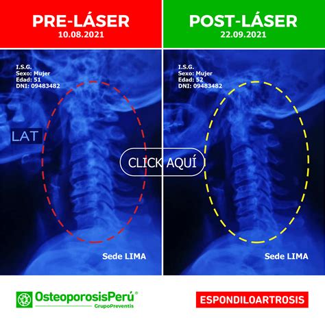 Espondiloartrosis Osteoporosis Perú