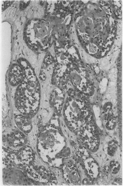 Adenoid Squamous Carcinoma An Download Scientific Diagram