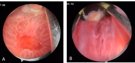 A The Cystoscopy Revealed Edematous Bladder Mucosa With Red Areas And