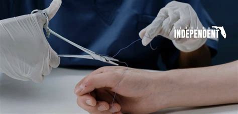 5 Techniques In Suturing To Practice Florida Independent