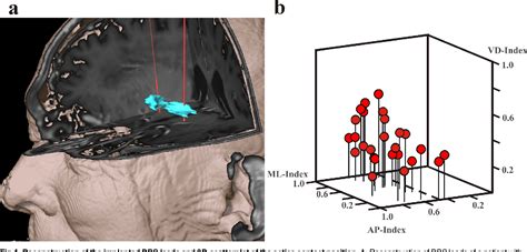 Figure 3 From Using Mdeft Mri Sequences To Target The Gpi In Dbs Surgery Semantic Scholar