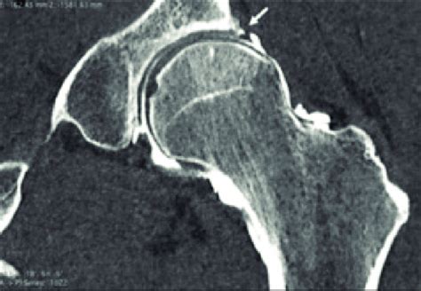Arthro Ct Shows The Lesion Of The Acetabular Labrum White Arrow Download Scientific Diagram
