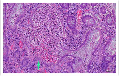 Ulcerative Colitis Biopsy Histology Dilated Glands Containing