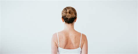 Cancro Da Pele Tudo O Que Deve Saber Para Evitar Este Problema De Saúde