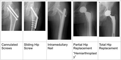 Partial Hip Replacement