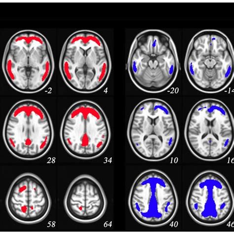 Disease Specific Cortical Target Regions Ad Alzheimers Disease