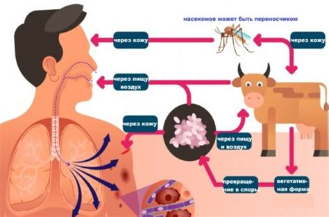 СИБИРСКАЯ ЯЗВА