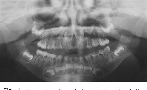 Figure 1 From Dentin Sialophosphoprotein Dspp Gene Mutation In A Korean Patient With
