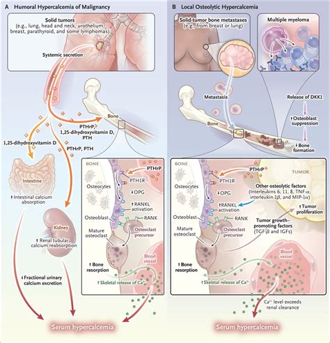 😱emergencies In Hematology😱 Hypercalcemia Of Malignancy Hom A Short 🧵 Medtwitter 117