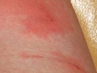 Cellulitis From Bug Bites Signs Symptoms And Treatment