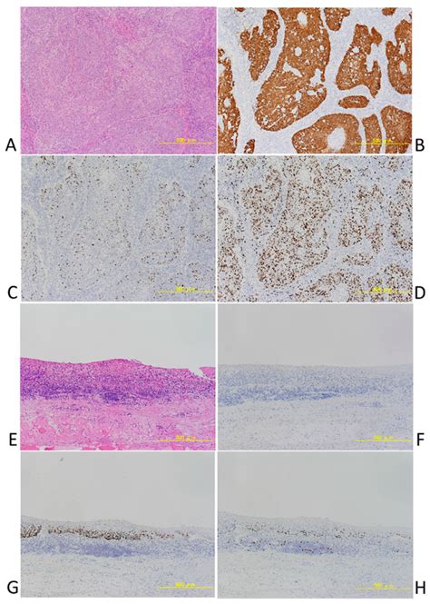Ad A Case Of P16 Positive Squamous Cell Carcinoma Of Oropharynx A