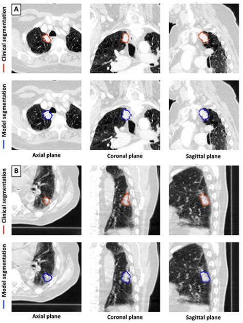 Ai Aids Lung Tumor Detection On Ct Rsna