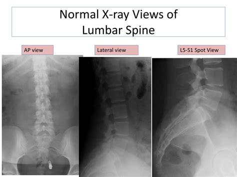 Ppt Lumbar Spine Powerpoint Presentation Free Download Id2521553