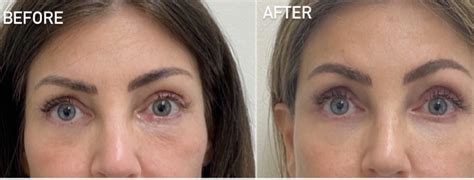 Morpheus8 Before And After Photos Skin Spa By Dr Kia