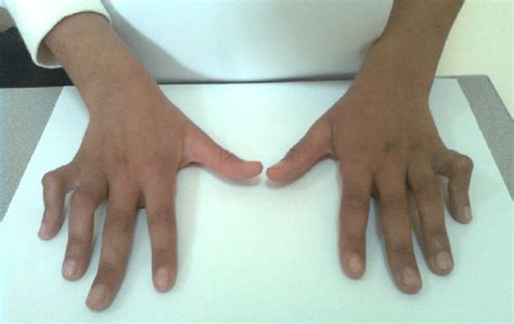 Flexion Contracture