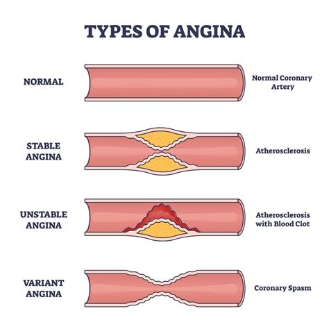 Angina Treatment Signs And Causes The Keyhole Heart Clinic