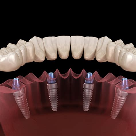 Dentures Coppell Tx Missing All Teeth Cost Of Dentures Donna L