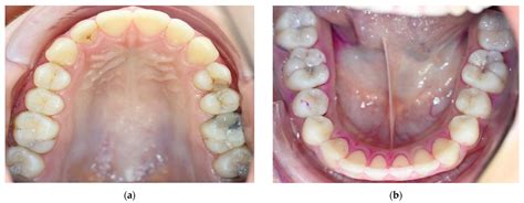 Introducing An Innovative Approach For Managing Proximal Non Cavitated Carious Lesions In