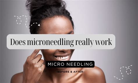 How To Microneedle Scalp