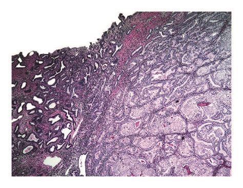 Endometrial Adenocarcinoma Endometrioid Type With Squamous Download Scientific Diagram